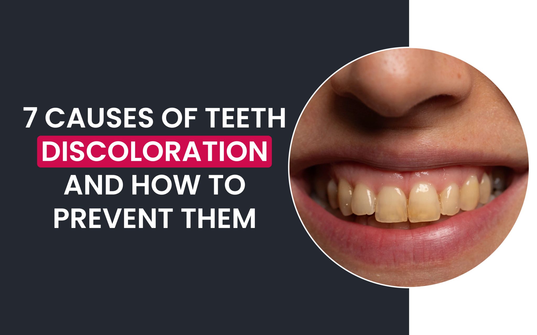 7 Causes of Teeth Discoloration and How to Prevent them
