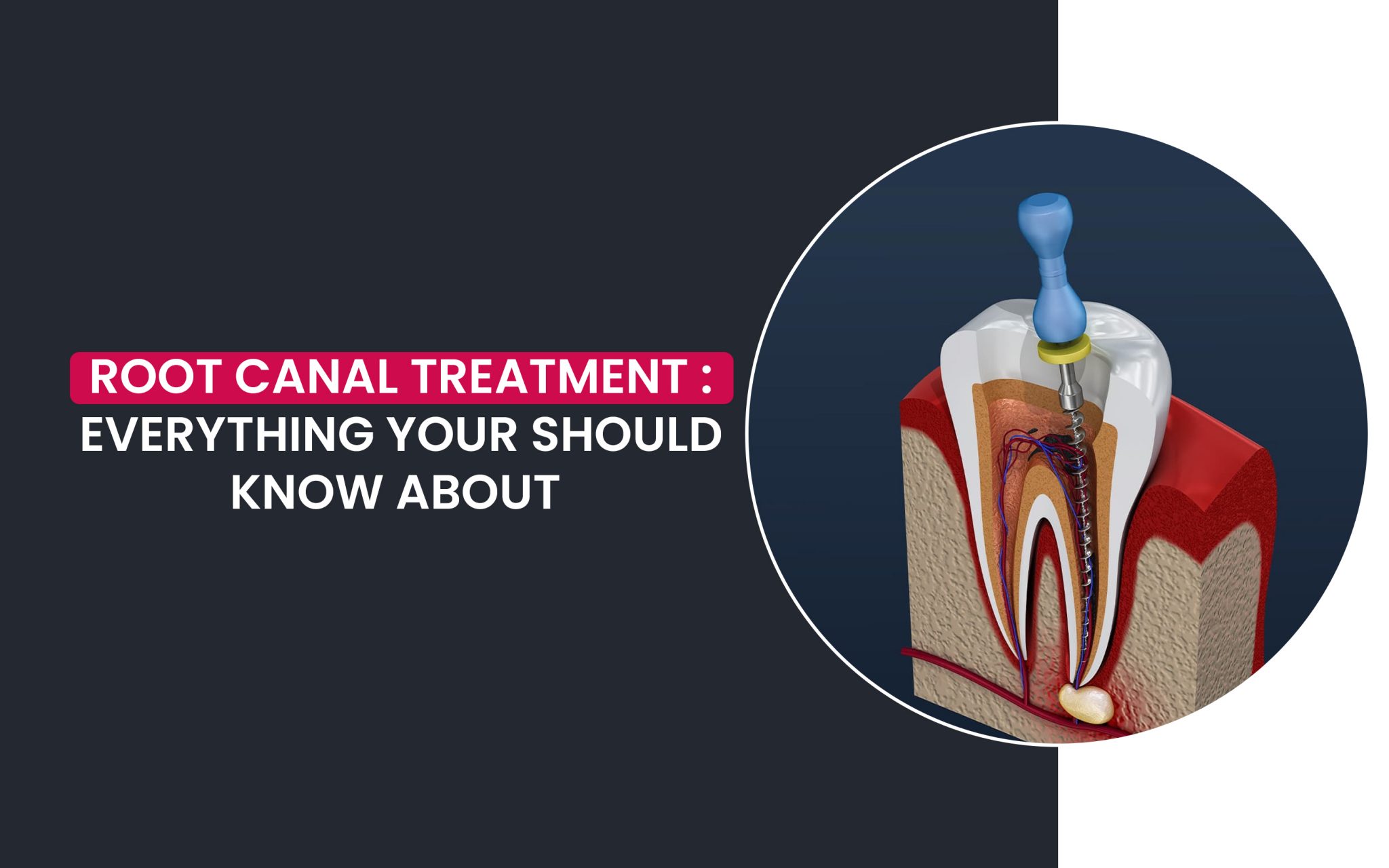 Root Canal Treatment : Everything You Should Know About