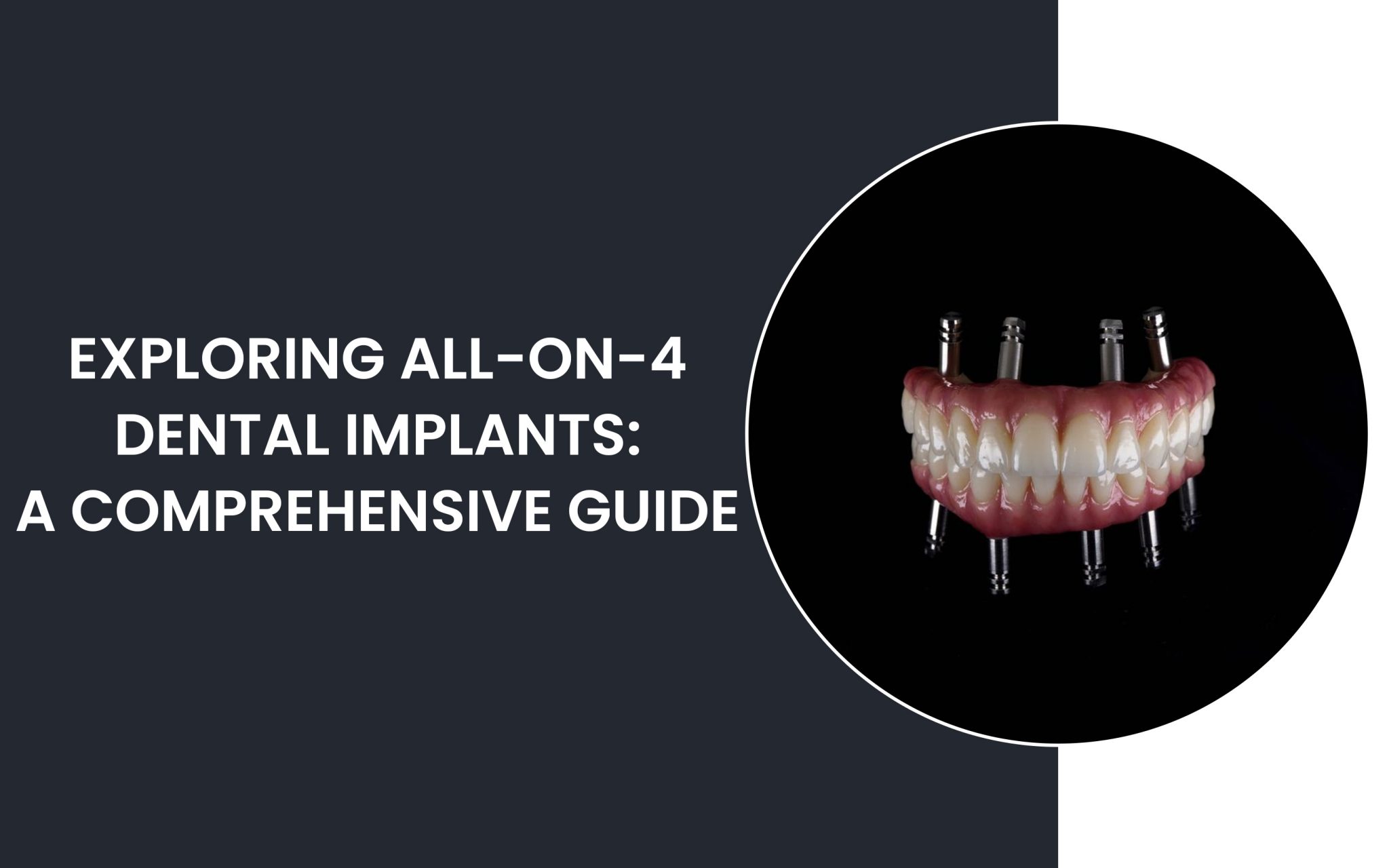 Exploring All-on-4 dental implants: A comprehensive guide | Paradise ...